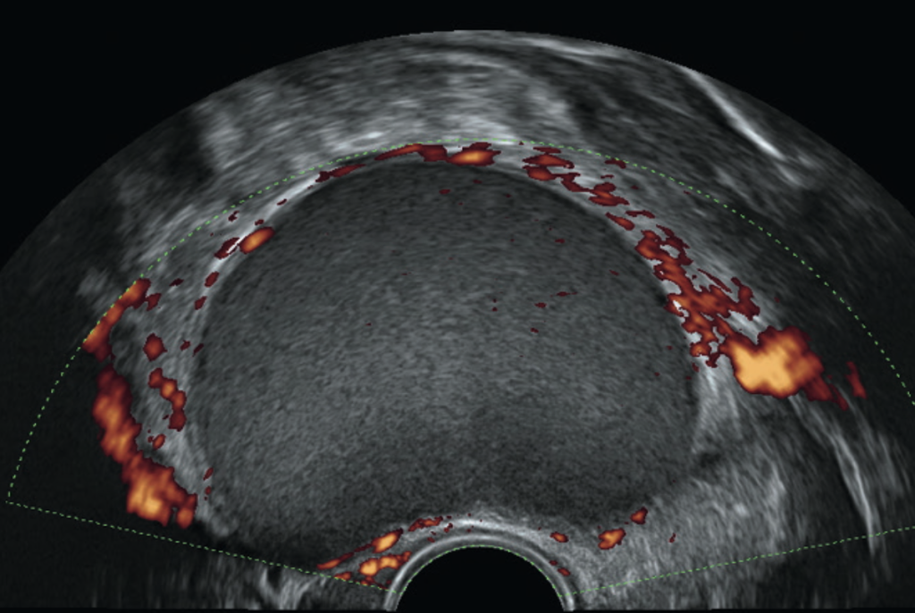 Endométriose | Imagerie Duroc